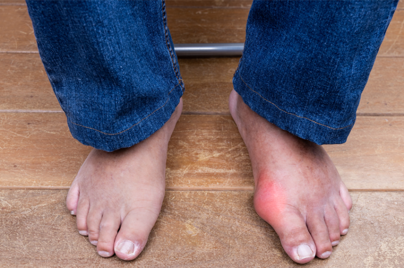 ¿Sabes que es La Gota y cómo prevenir esta enfermedad?